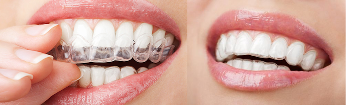 Mon expérience de l’orthodontie adulte par gouttières type Invisalign ...