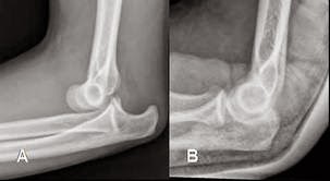 Lesiones de élite: Luxación de codo.