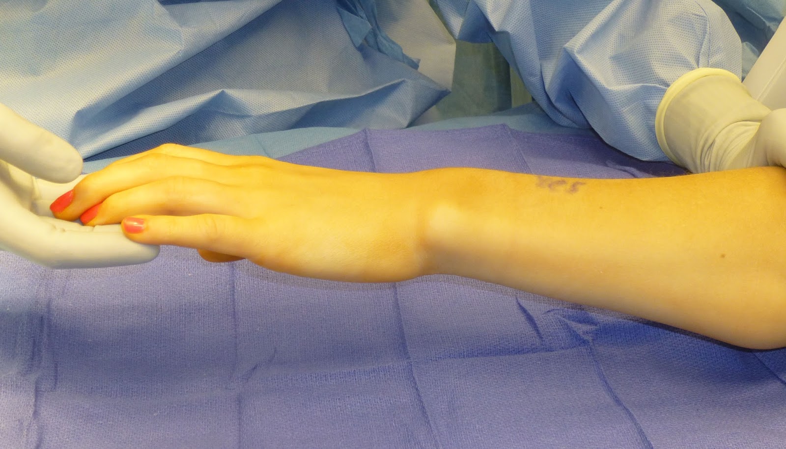 Traumatic Madelungs Deformity | Congenital Hand and Arm Differences ...