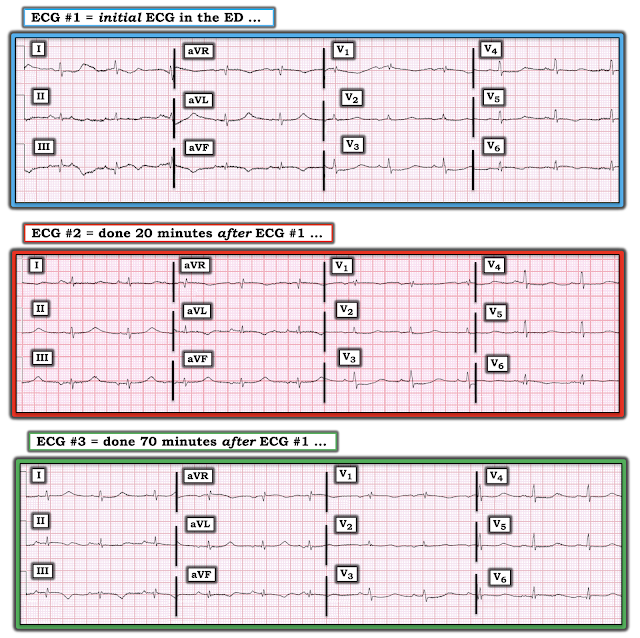 Dr. Smith's ECG Blog: August 2020
