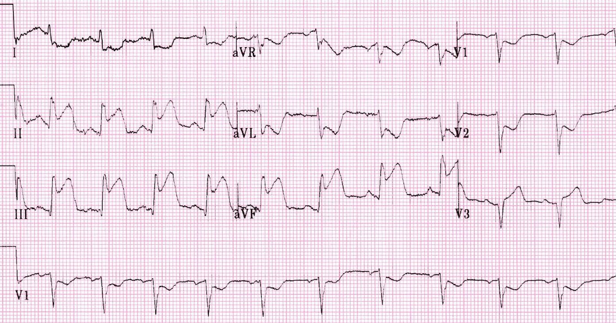 Study Medical Photos: Acute Right Ventricular Myocardial Infarction - ECG