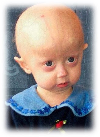 Perdidas entre libros: Síndrome de Progeria de Hutchinson-Gilford- Etiología