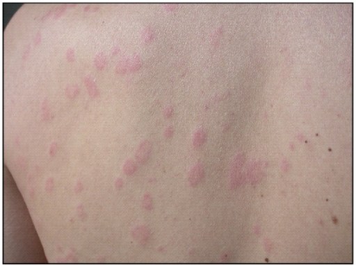 Urticaria , what and how to overcome them | Health articles for healthy ...