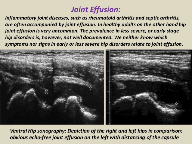 SONOGRAPHIC ANATOMY HIP JOINT AND JOINT EFFUSION