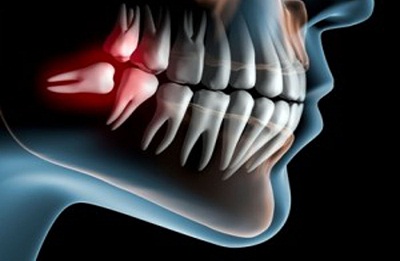 tooth abscess : Wisdom Teeth Removal
