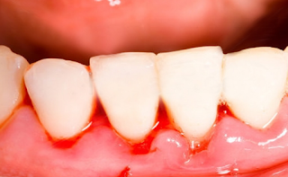 What Bleeding (or No Bleeding) of Your Gums Really Means - An Ode to ...