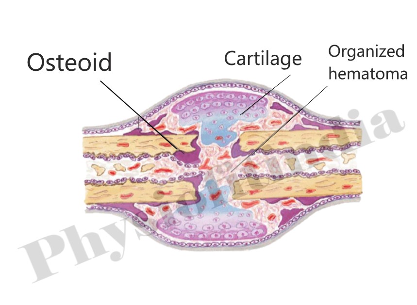 Types of Fracture,symptoms,Healing stages,Management,Physiotherapy ...
