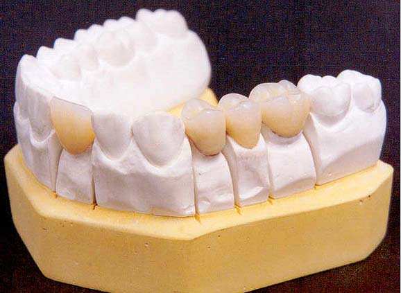 IN - CERAM ~ Laboratorio Dental Chrisdent