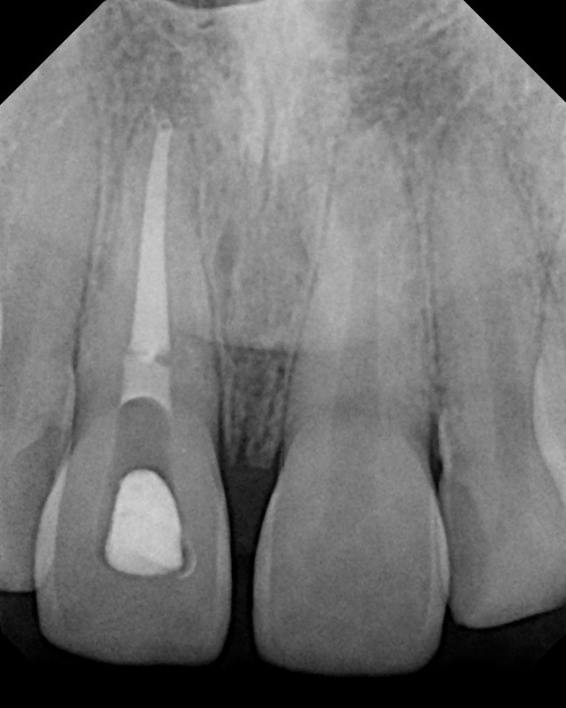 The Endo Blog: Internal bleaching makes us smile!