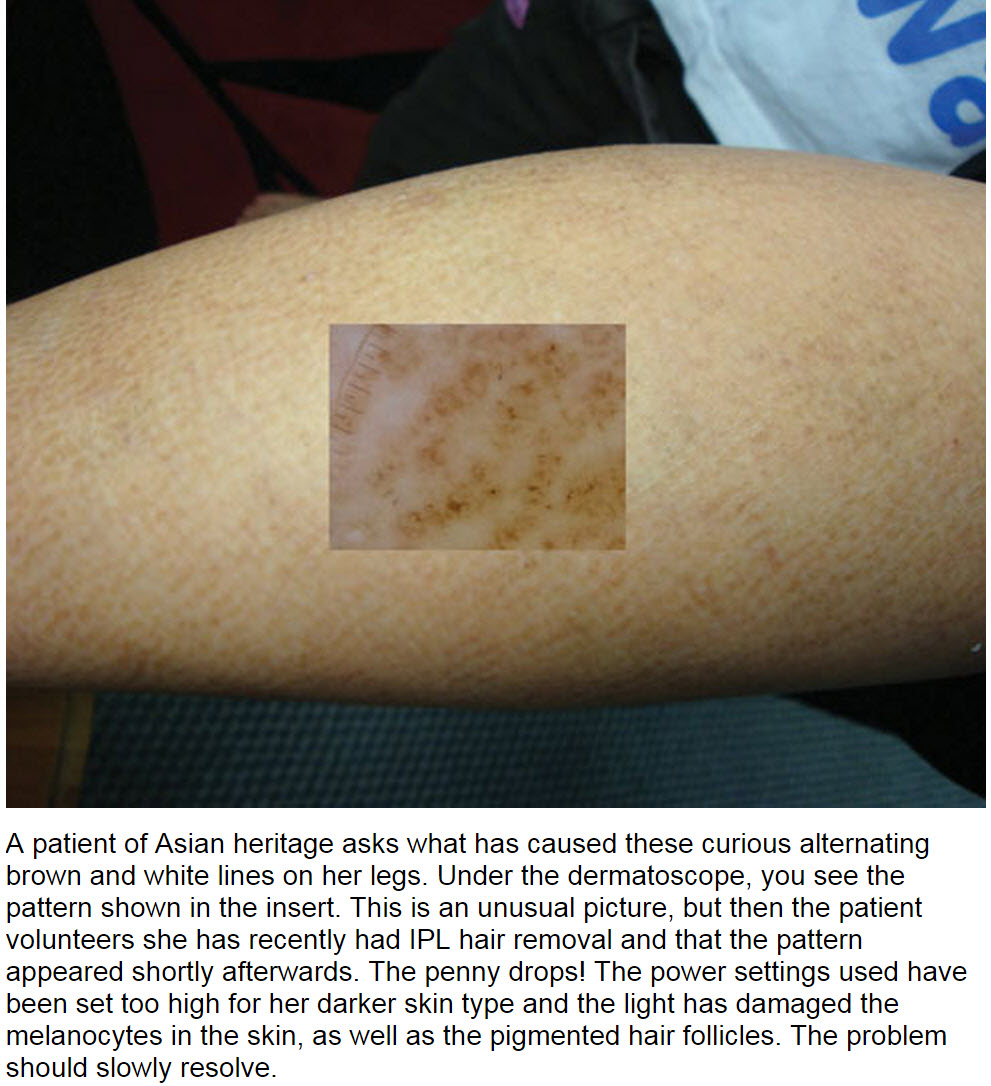 Consultations in Dermatology: Complications of IPL