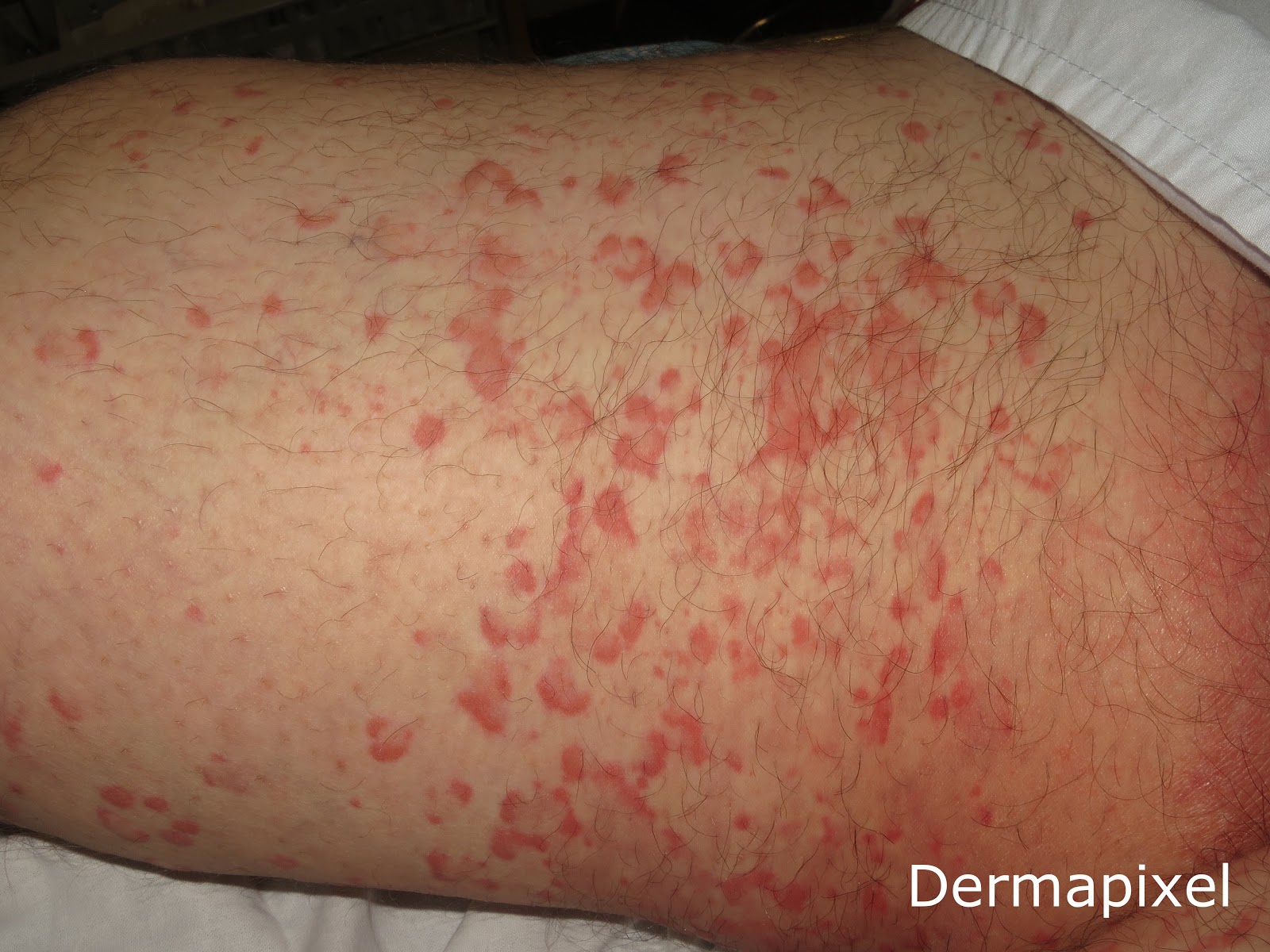Urticaria Adrenergica