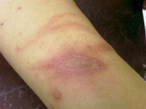 Knowledger80: Memahami dan Menghadapi Serangga Tomcat ( Paederus ...