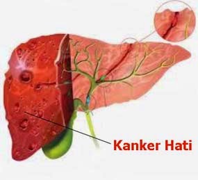 Penyebab Dan Gejala Kanker Hati ~ Blog Pindahan