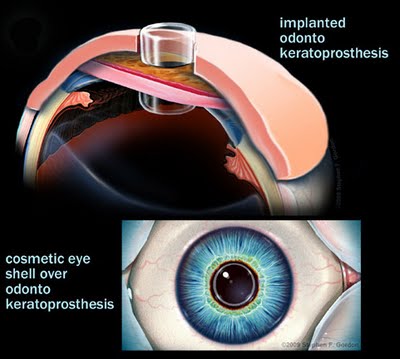 dentisTRY: EYETOOTH IMPLANT: Tooth implantation in eye for blind person
