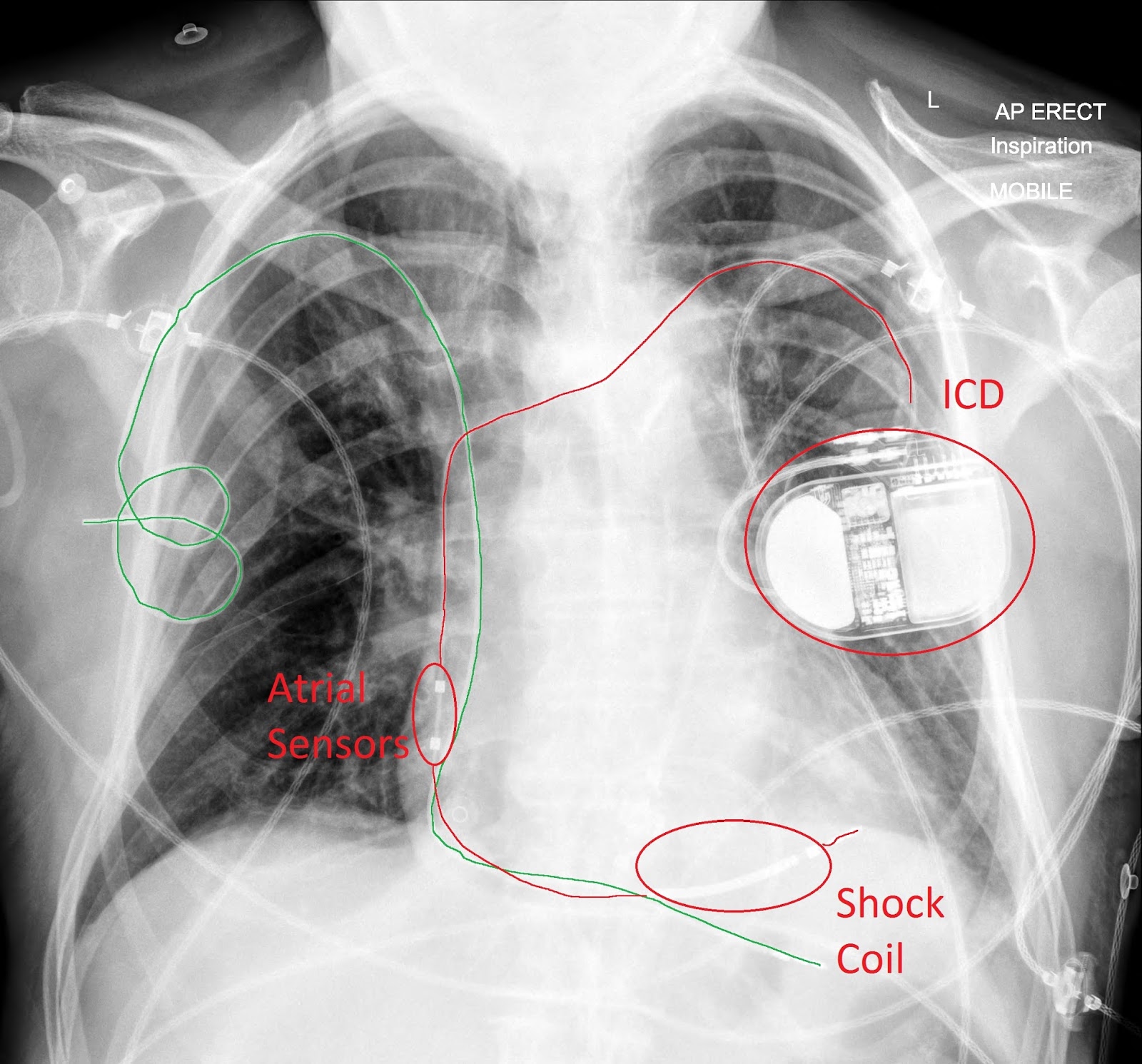 ECG of the Week: ECG of the Week - 18th January 2015 - Interpretation