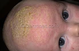 Malassezia Yeast : Malassezia