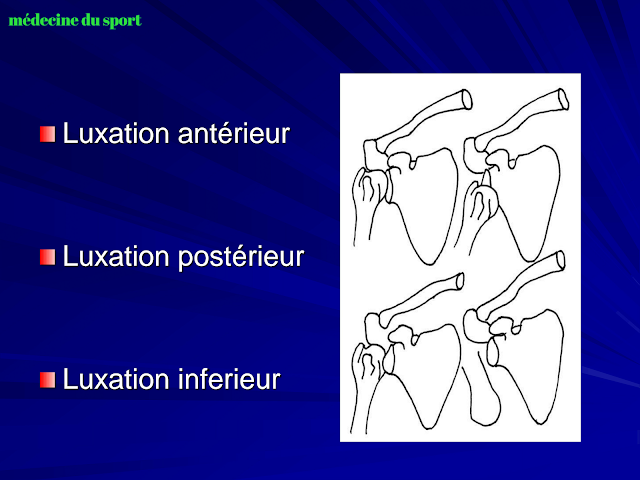 Les Luxations de l’épaule