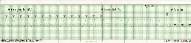 Megacode: Unstable Ventricular Tachycardia Part 3