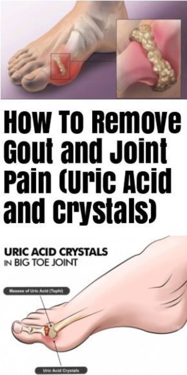 How To Quickly Remove Uric Acid Crystallization From Your Body To ...