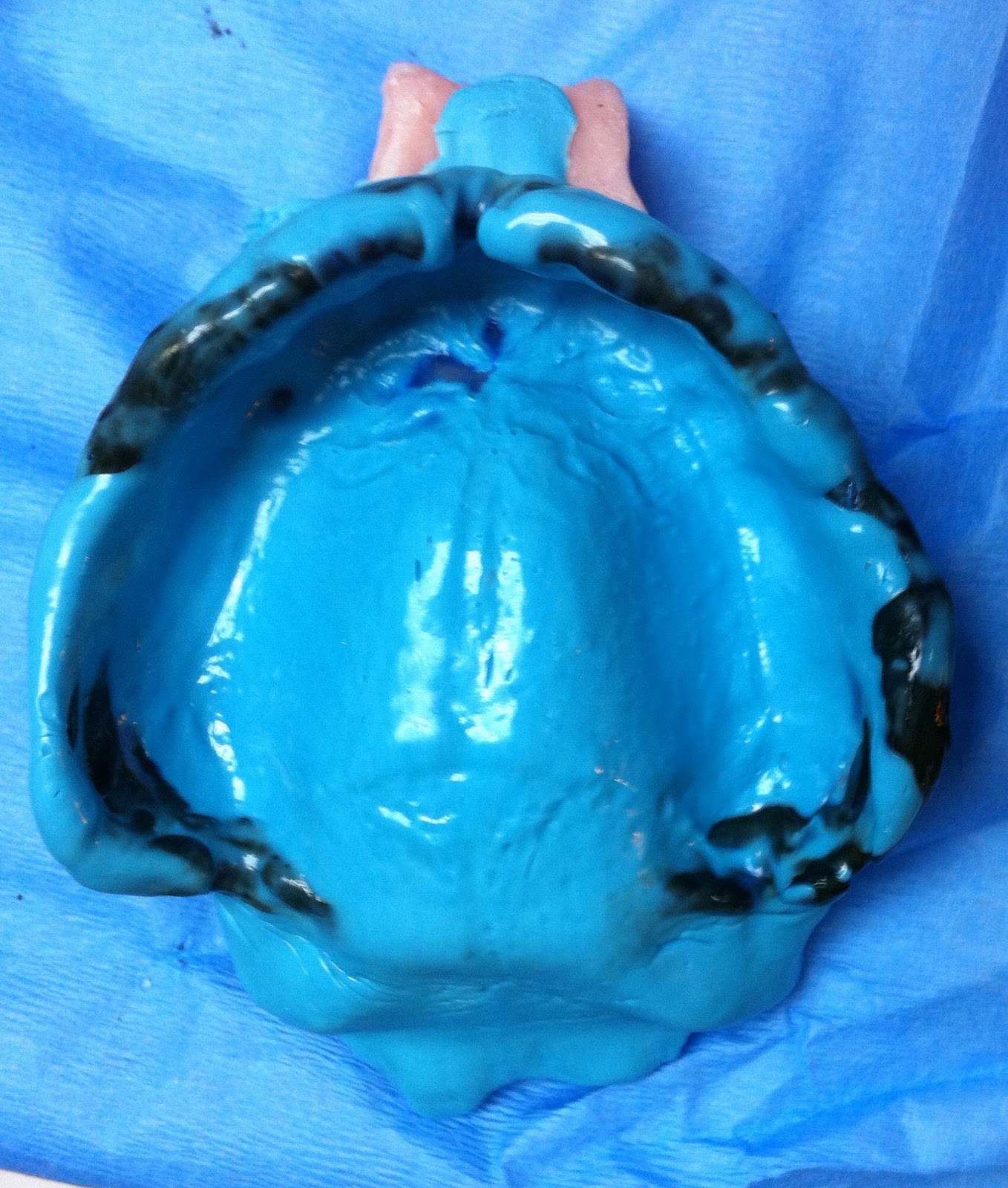 Odontología: Prótesis Total Superior Fotos