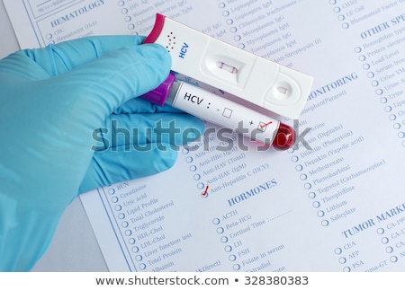 تحاليل الفيروسات / شرح شامل لكل من تحليل فيرس C و B و A - التحاليل ...