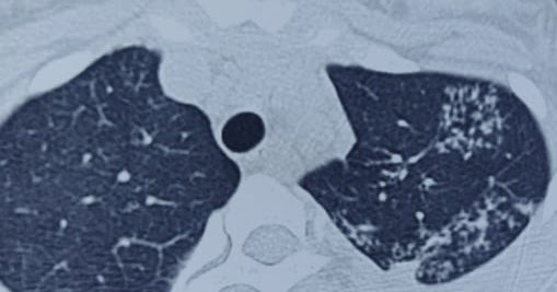 Tree in Bud Appearance: CT - Sumer's Radiology Blog