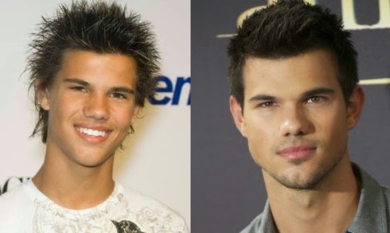 Taylor Lautner Nose Job