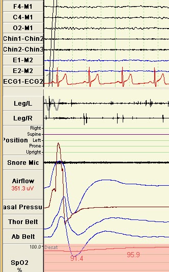 Sleep and Neurology: Cardiac Variability at Night During Apneas ...