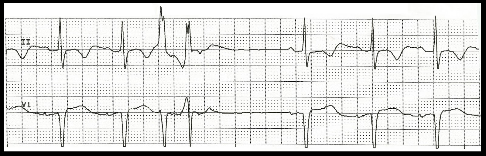 Practice EKG Rhythm Strips 164