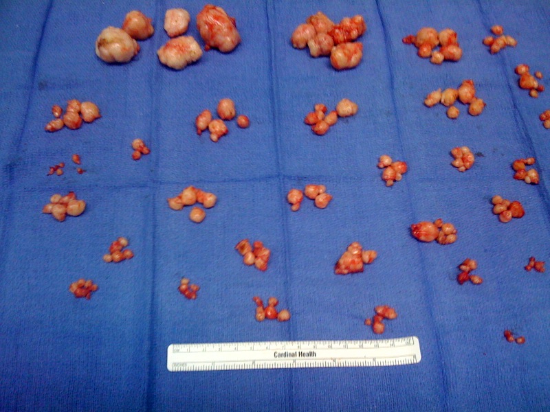 Fibroids During Pregnancy Learn How To Deal With And Get Rid Of