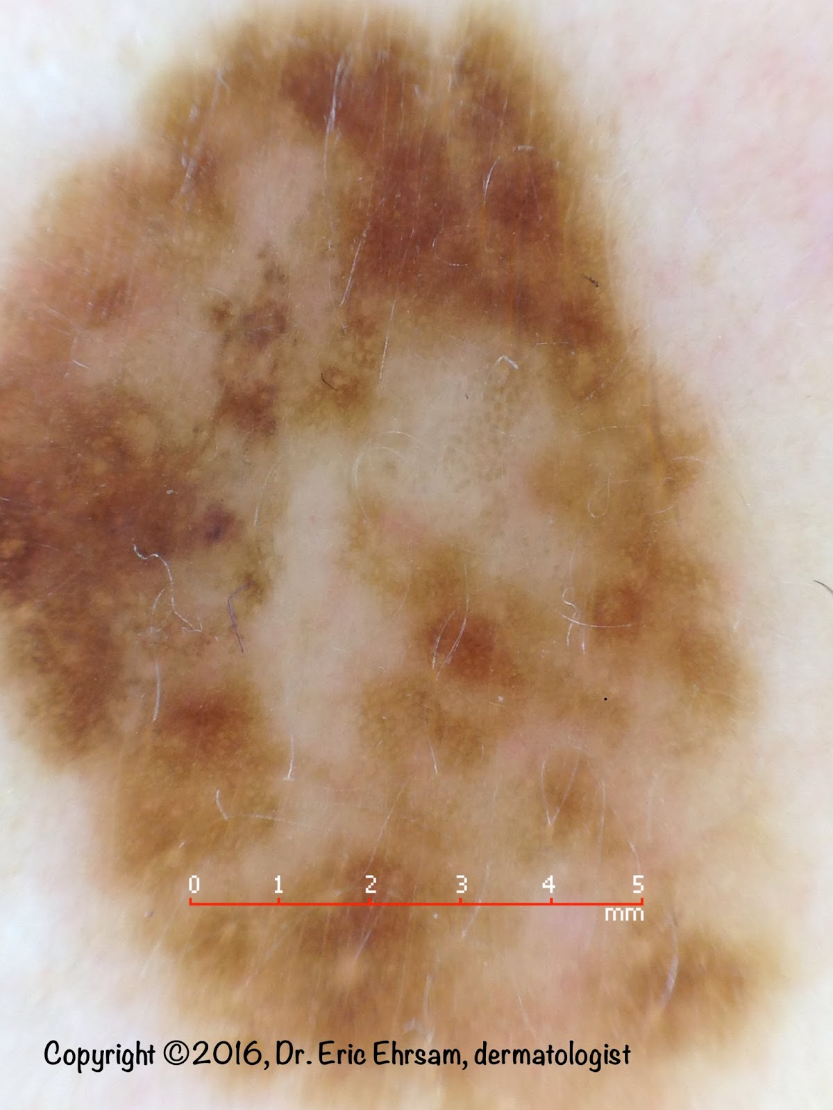 dermoscopy: A pigmented lesion on a shoulder