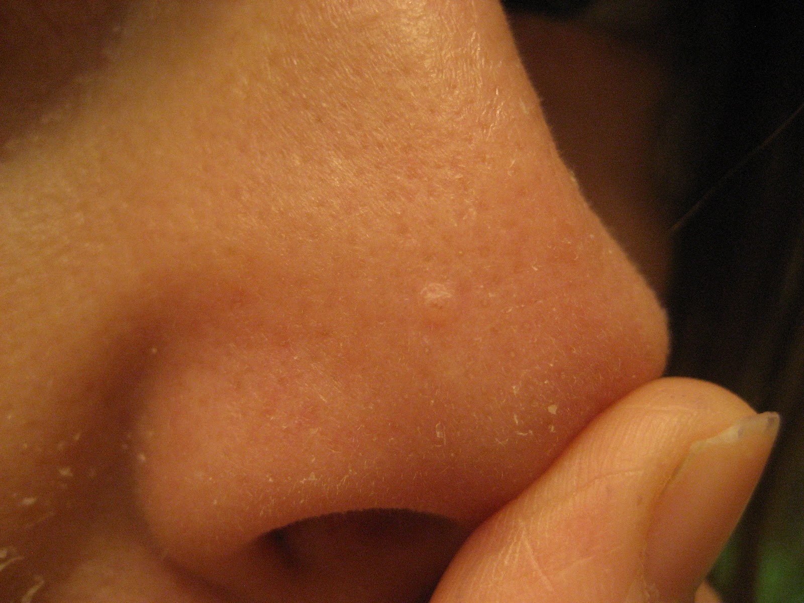 Chemical Peels for Acne and Anti Aging: Complete Mole Removal with TCA ...