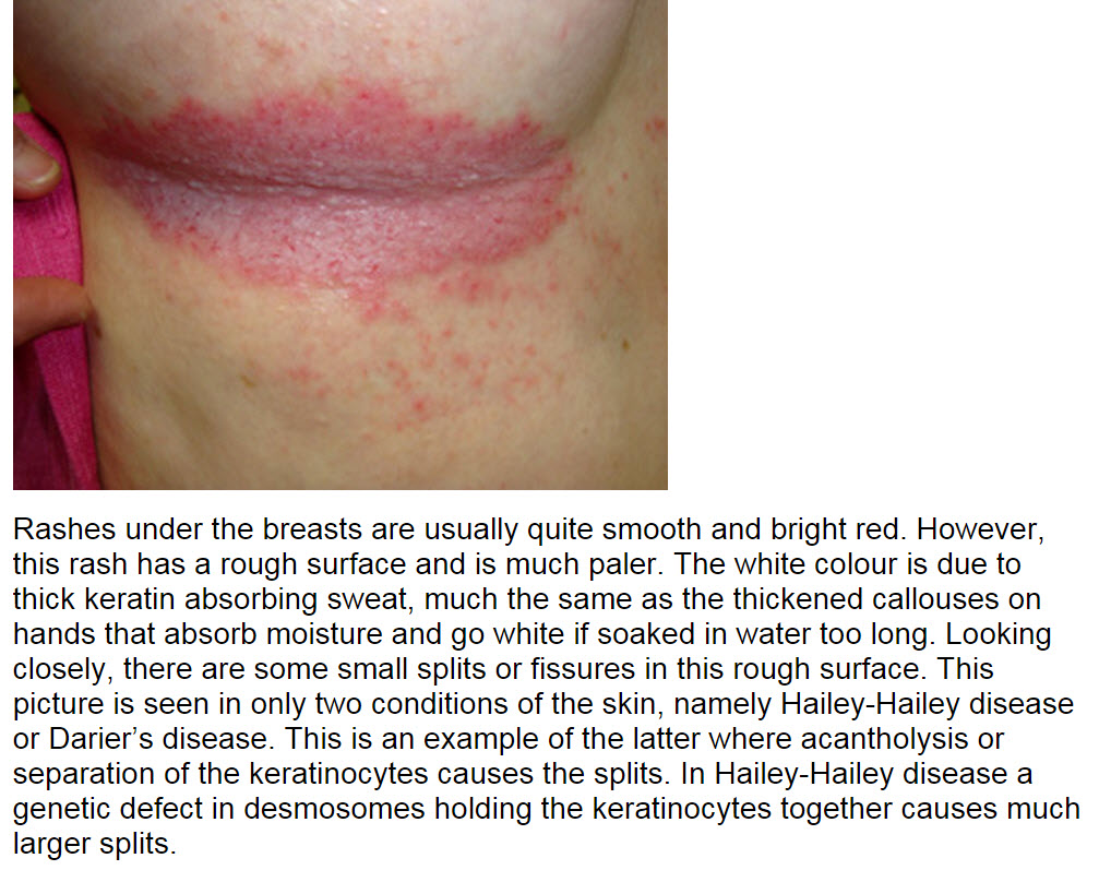 Consultations in Dermatology: Darier's disease breast