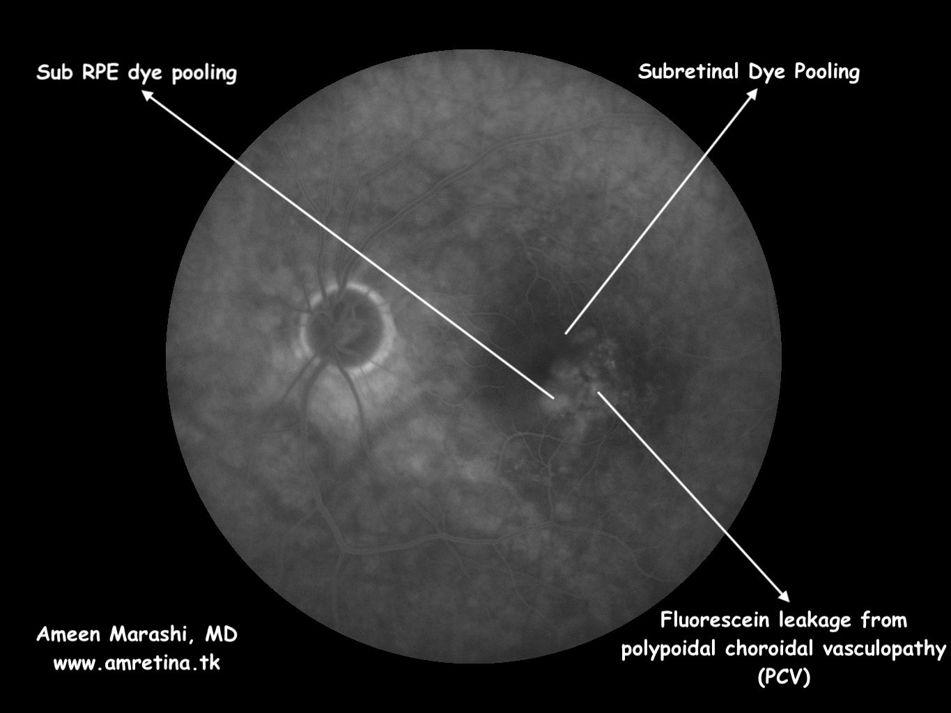 Polypoidal choroidal vasculopathy