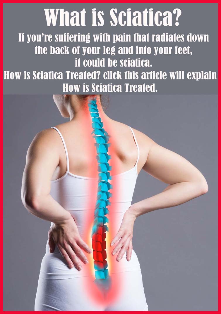 Practical Sciatica Relief Information What Is Sciatica Practical Sciatica Relief Information What Is Sciatica