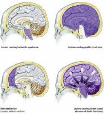 Síndrome apálico o síndrome de vigilia sin respuesta (UWS)