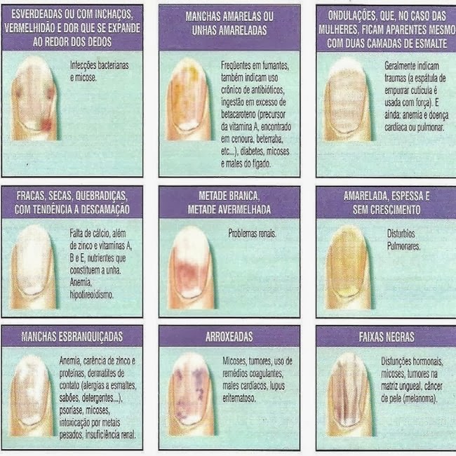 Patrícia Aprendendo: Unhas descamando!