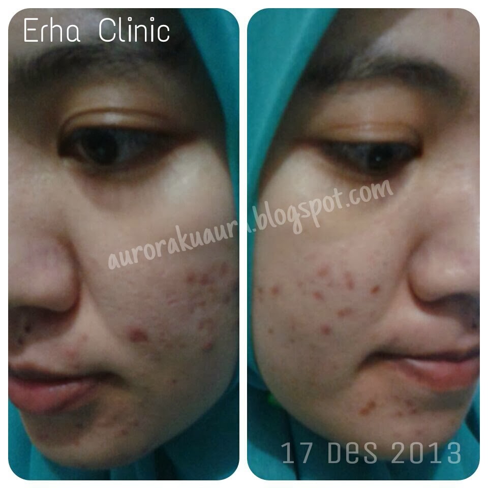 Auroraku: akhirnya mencoba Erha Clinic (di Samarinda) juga..