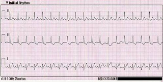 médicos latinos : TROMBOEMBOLISMO PULMONAR (TEP)
