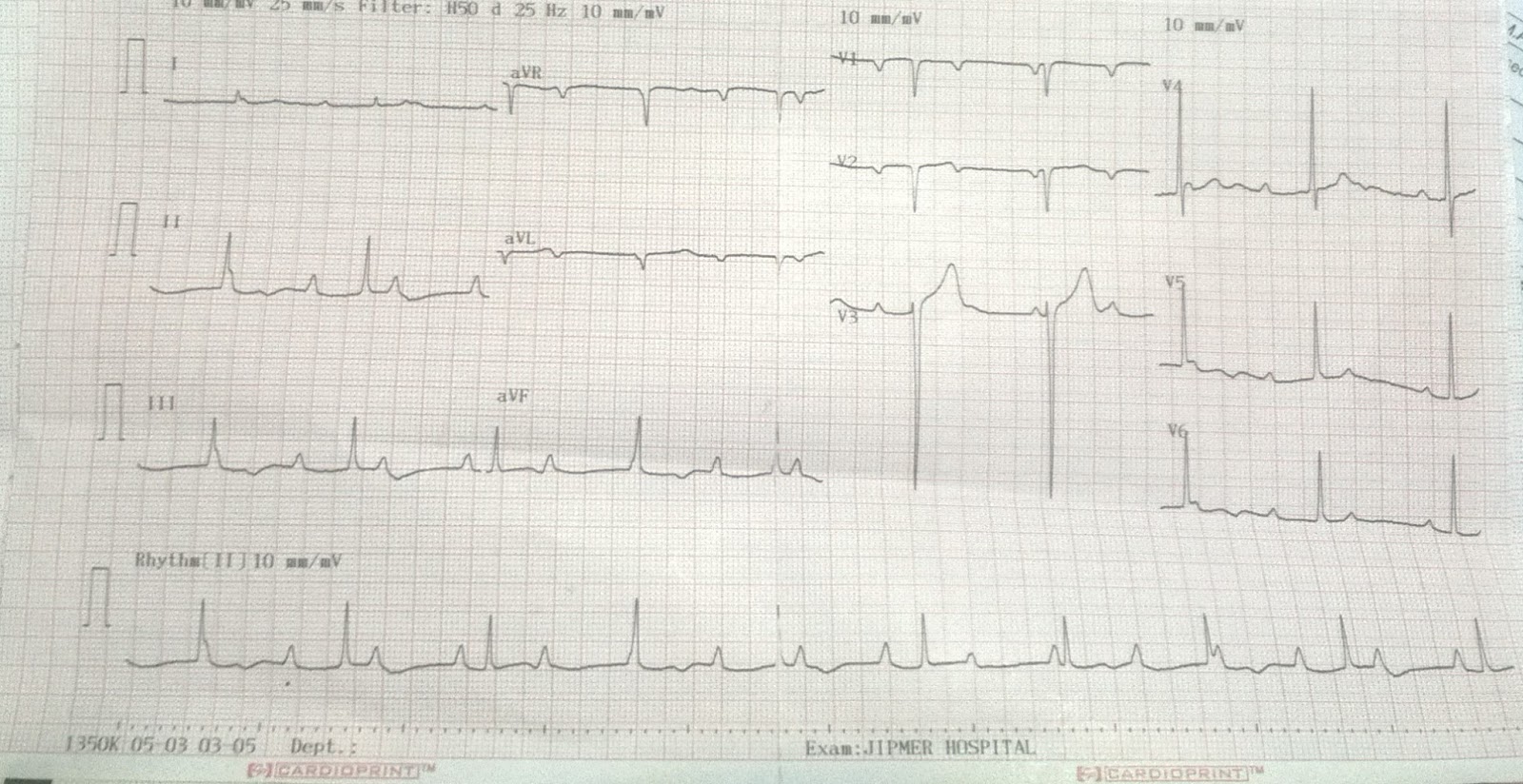 Cardiology window: PSVT patient develop CHB post radiofrequency ablation