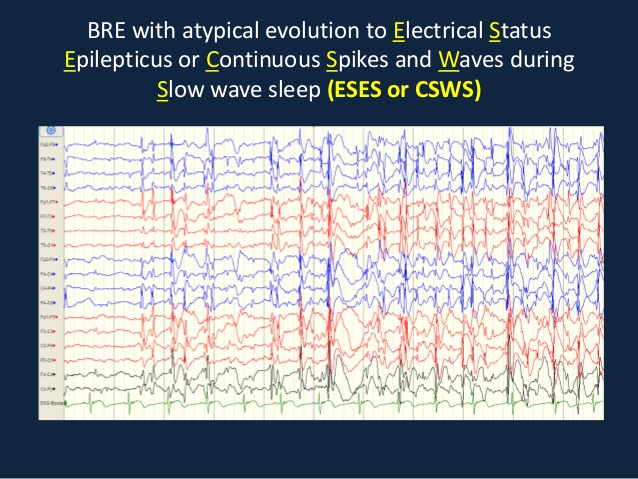 ESES (Electrical status epilepticus in sleep *Yavaş Uykuda Elektriksel ...