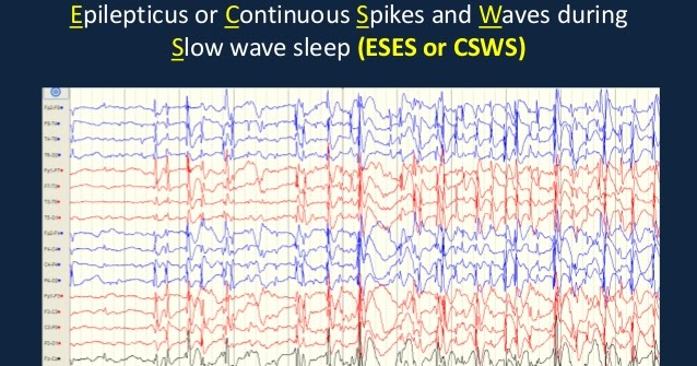Şapşik Anneden Notlar :): ESES (Electrical status epilepticus in sleep ...