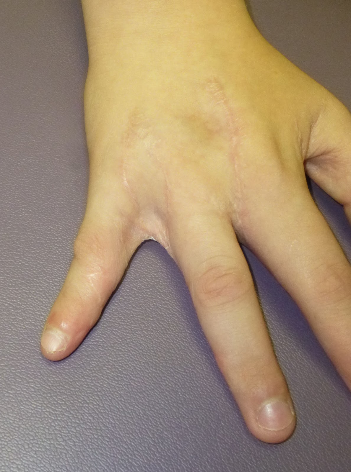 Cleft Hand Long Term Follow- up | Congenital Hand and Arm Differences ...