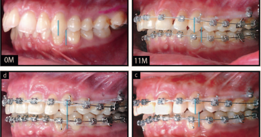 ORTODONTIA CONTEMPORÂNEA: Implantes extra alveolares: Aço ou Titânio ...