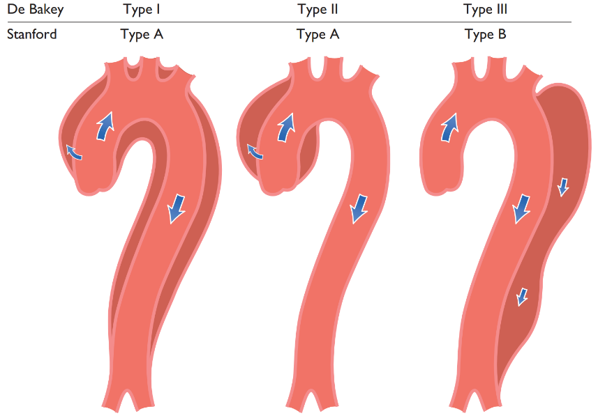 Hội chứng động mạch chủ cấp - Những điều cần biết