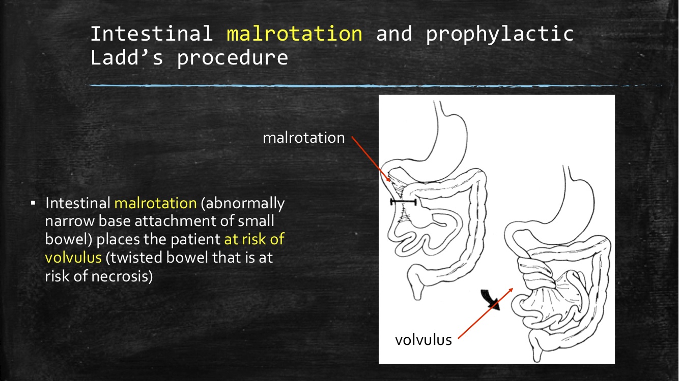 Once Upon A Prayer: Lily's Intestinal Malrotation