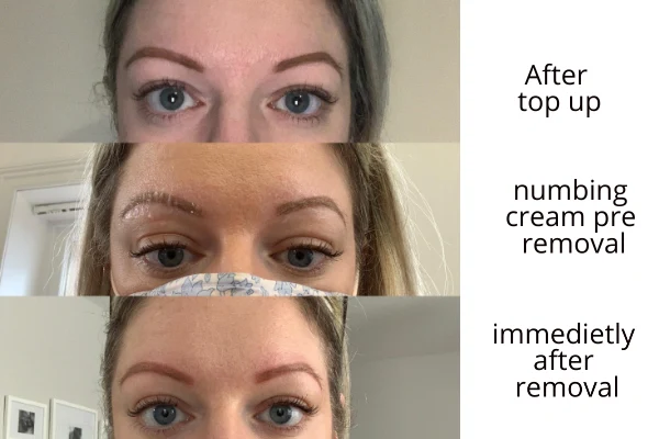 Arthurwears: Semi-Permanent Eyebrow Healing Journey | Emergency Removal