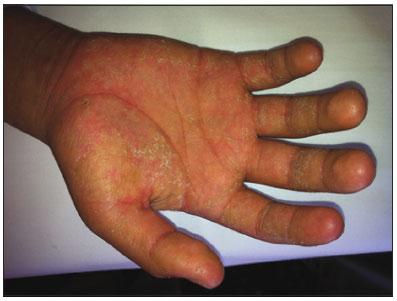 Sin amalgamas: Desintoxicación de mercurio: Epidemias de intoxicación ...