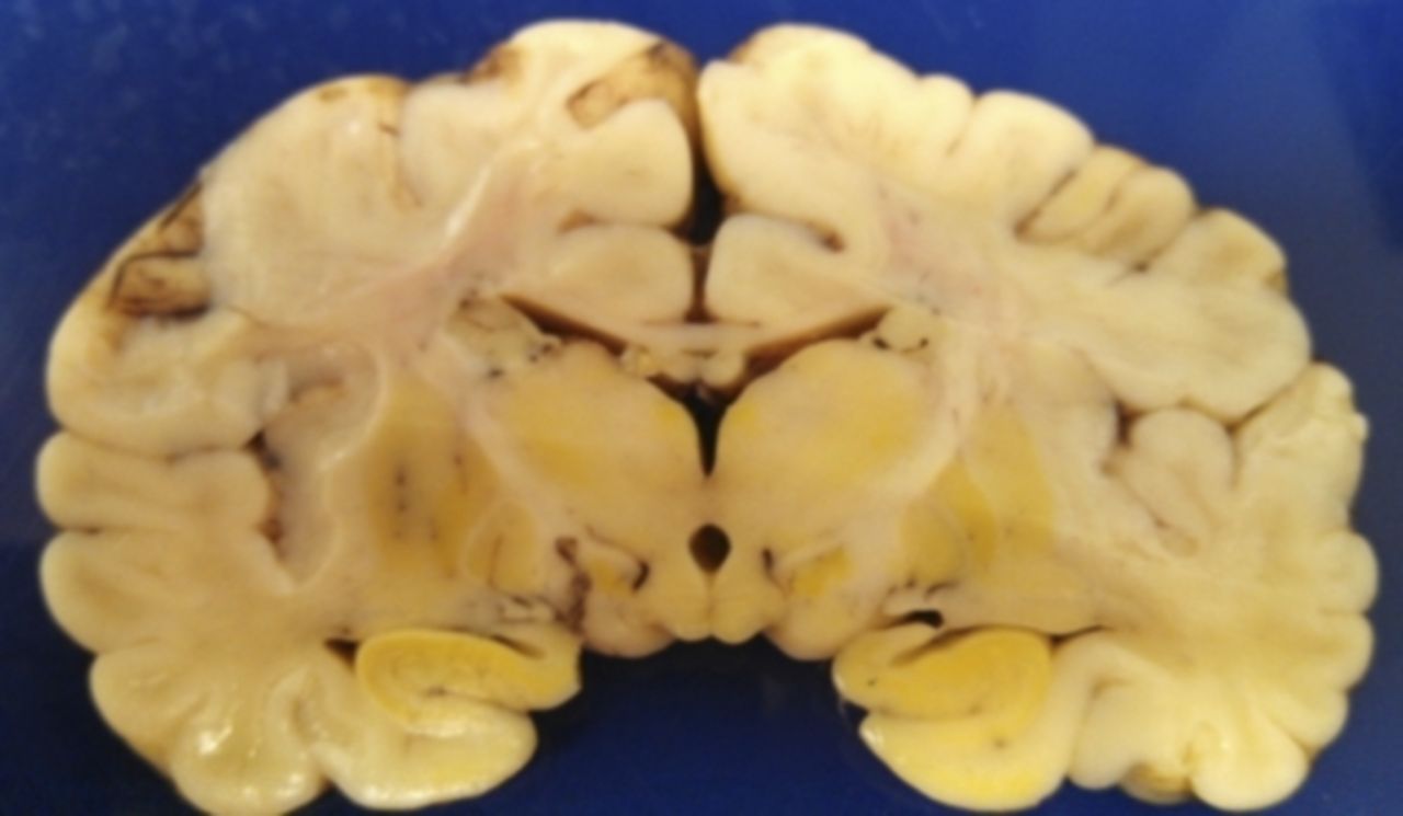 Kernicterus ~ Medical Resume