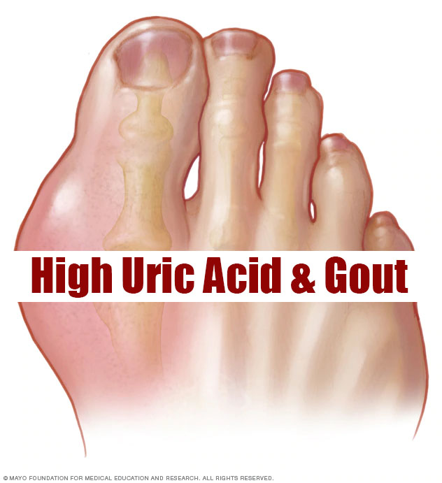 Doc Willie Ong Gamot Sa Uric Acid | Mabisang Lunas Sa Mataas Ang Uric ...